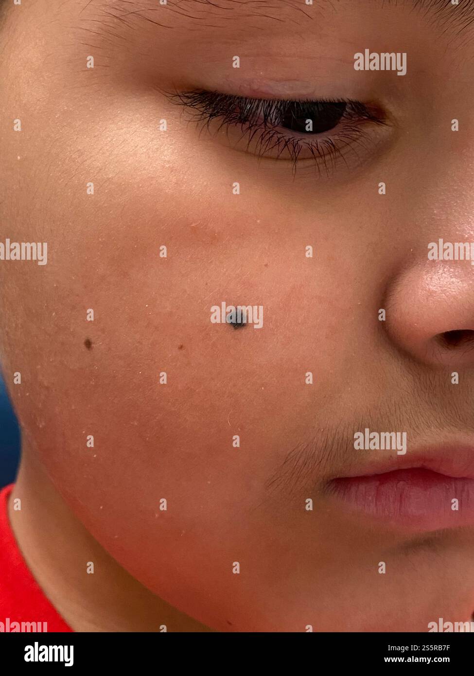 Reed nevus on the cheek of a 10 year old Hispanic boy. This dark star ...