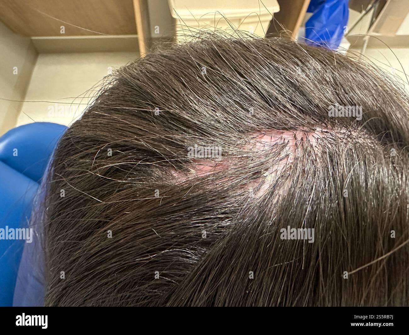 Scalp of a patient with hair loss caused by lichen planopilaris. Lichen ...