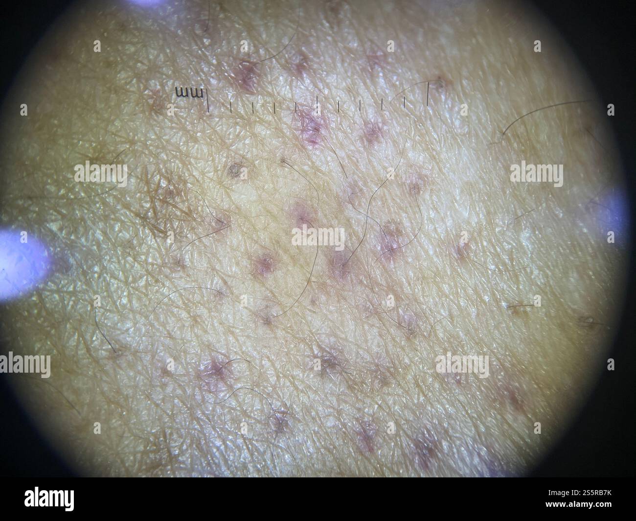 Dermatoscope image of the skin of a 45 year old African American male ...