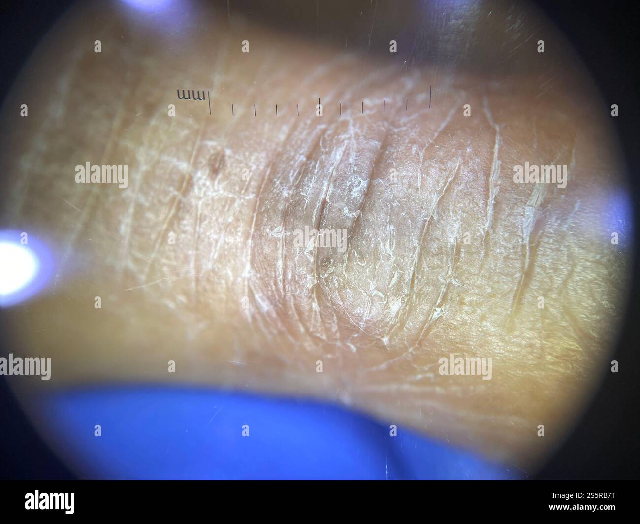 Dermatoscope image of the skin of a 45 year old African American male ...