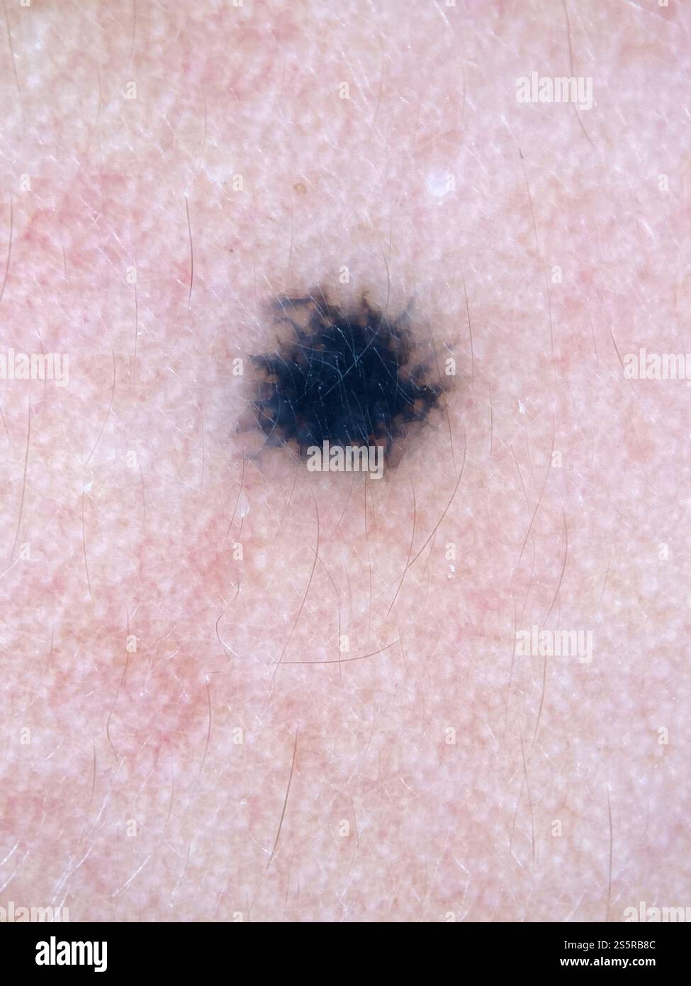 Dermatoscope image of a Reed nevus on the skin of a 10 year old ...
