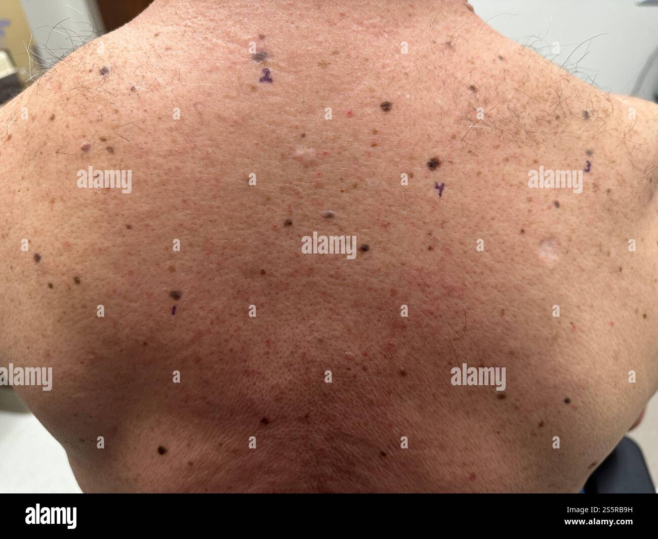 Reticular, or acquired (dark brown), and blue naevi on a 71 year old ...