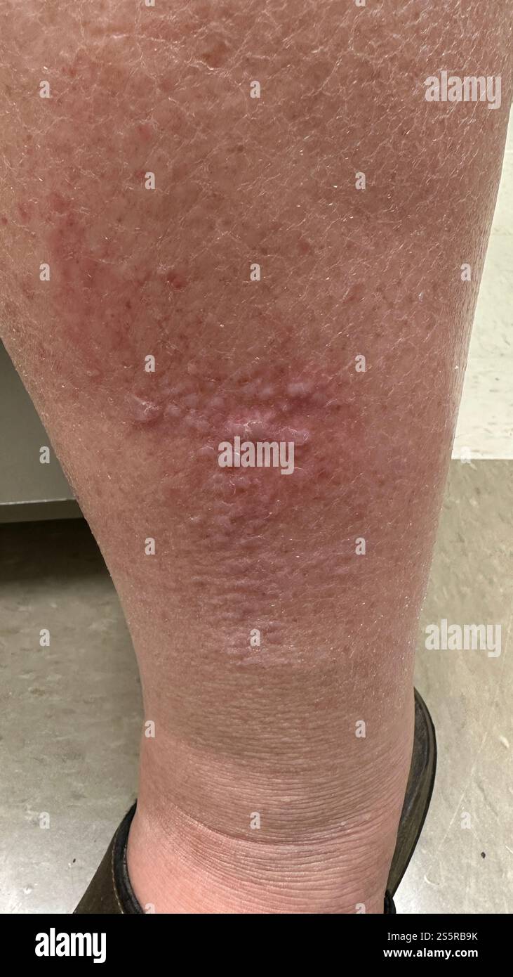 Leg of a patient with mild lymphoedema. Lymphoedema (swelling) is an ...