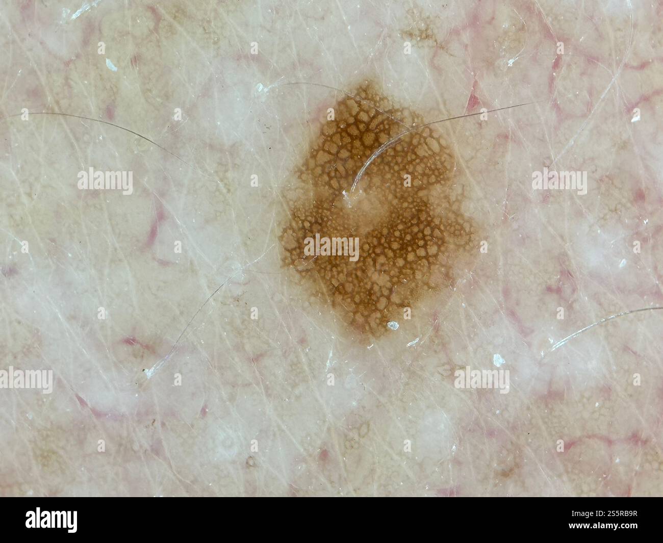 Dermatoscope image of a reticular, or acquired, naevus (dark brown) on ...