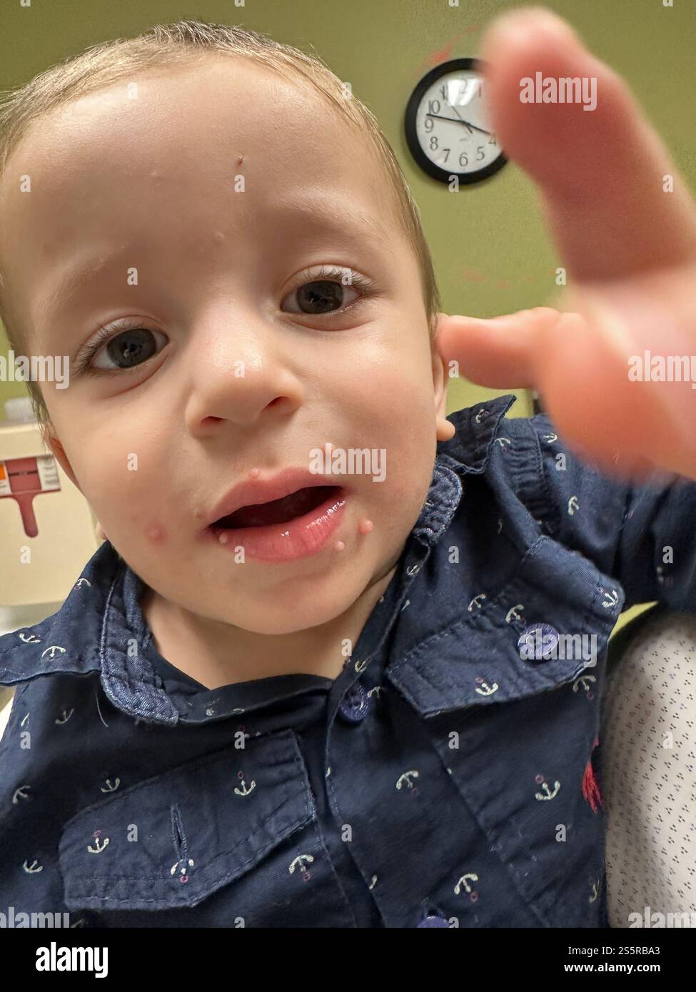 Papules on the face of a young child with molluscum contagiosum, a ...