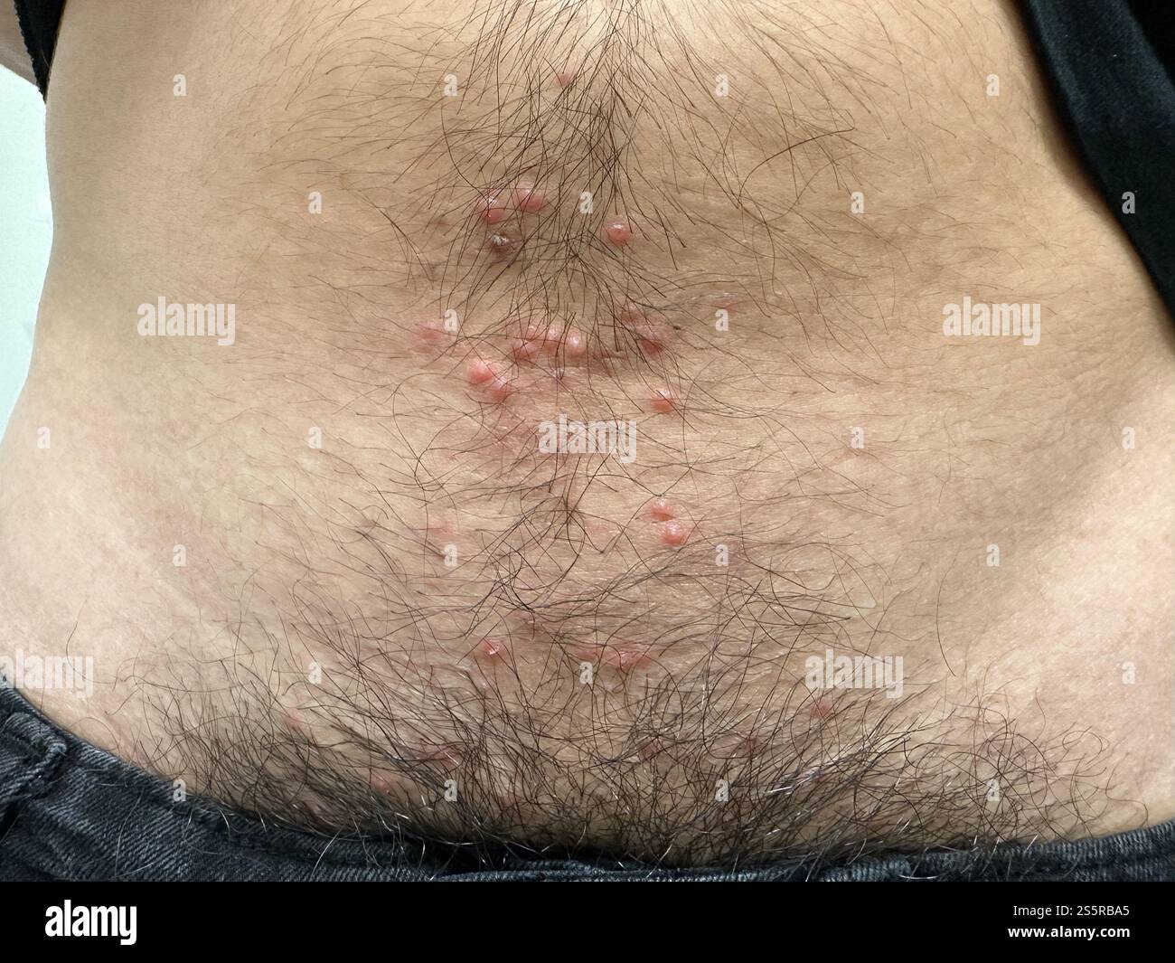Papules on the lower abdomen of a patient with molluscum contagiosum, a viral infection of the ...