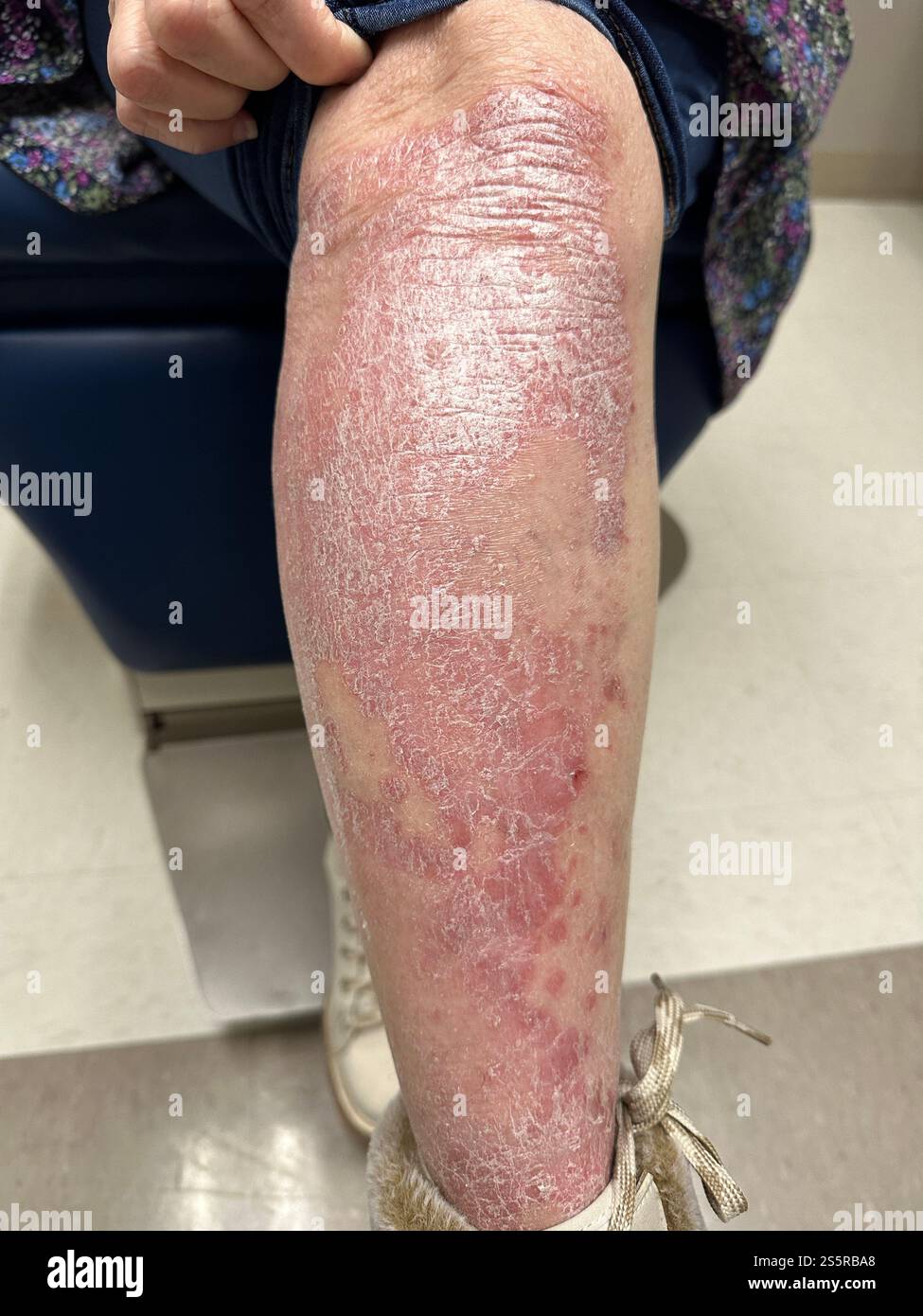 Psoriasis on a patient's leg. Psoriasis is a skin condition where ...