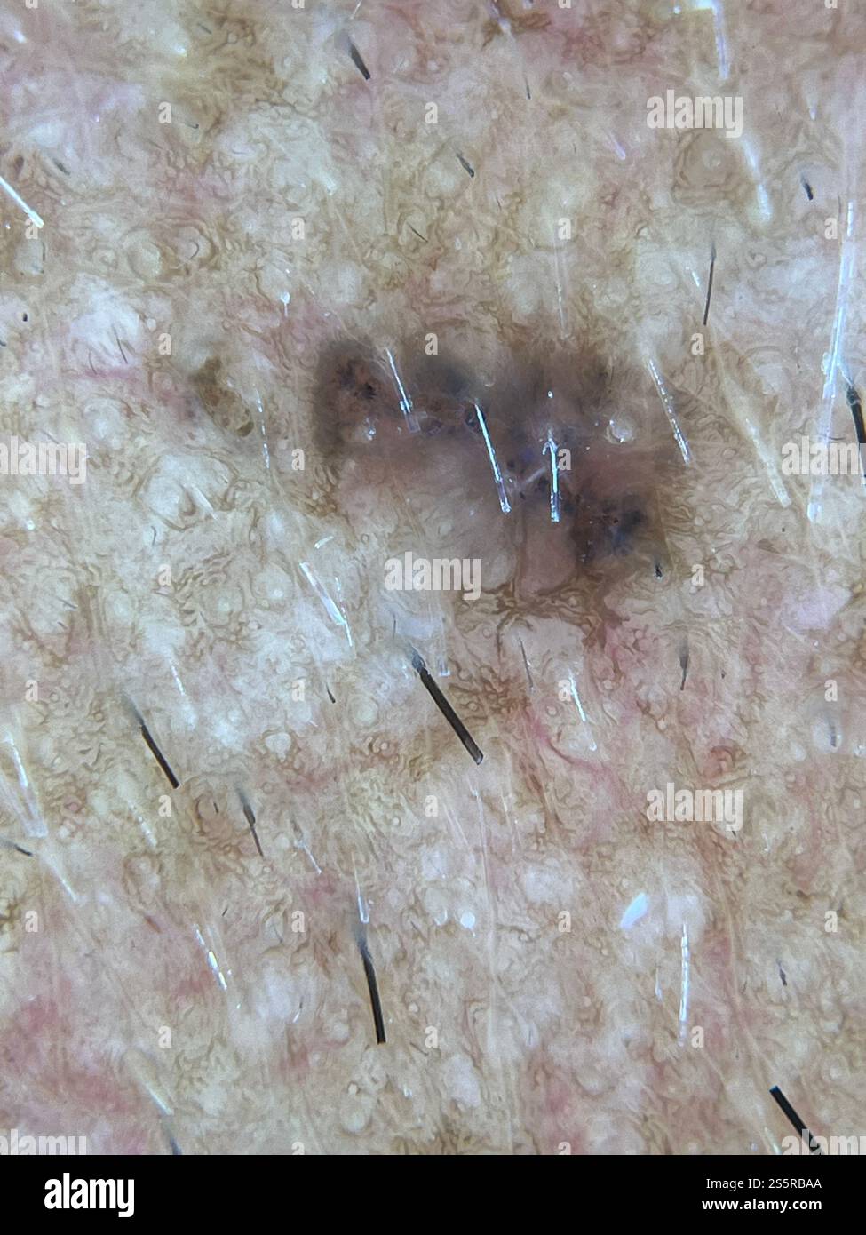 Dermatoscope image of a pigmented basal cell carcinoma (BCC), or rodent ...