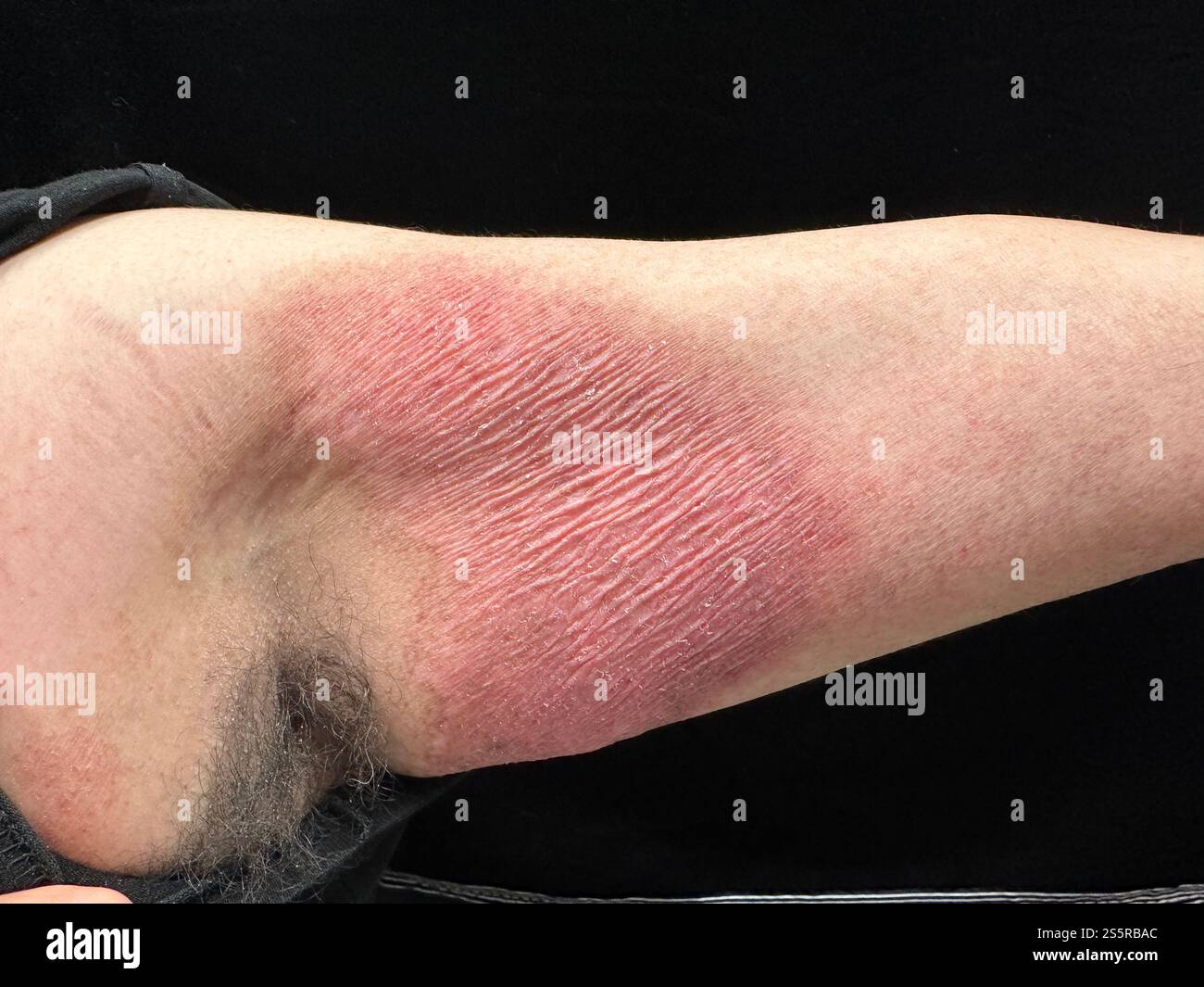 Mycosis fungoides plaque on a patient's arm that is being treated with ...