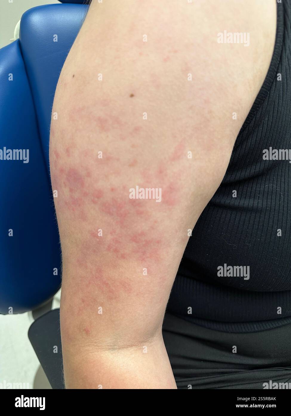 Redness on the arm of a 24 year old Hispanic female patient with ...