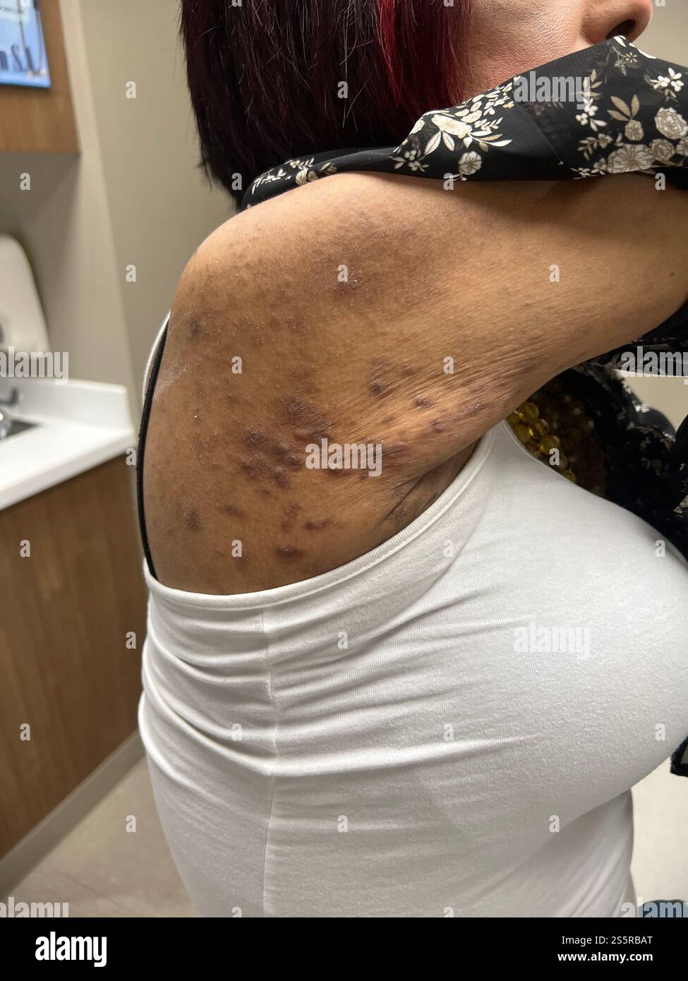 Shoulder of a 62 year old Hispanic female patient infected with scabies ...