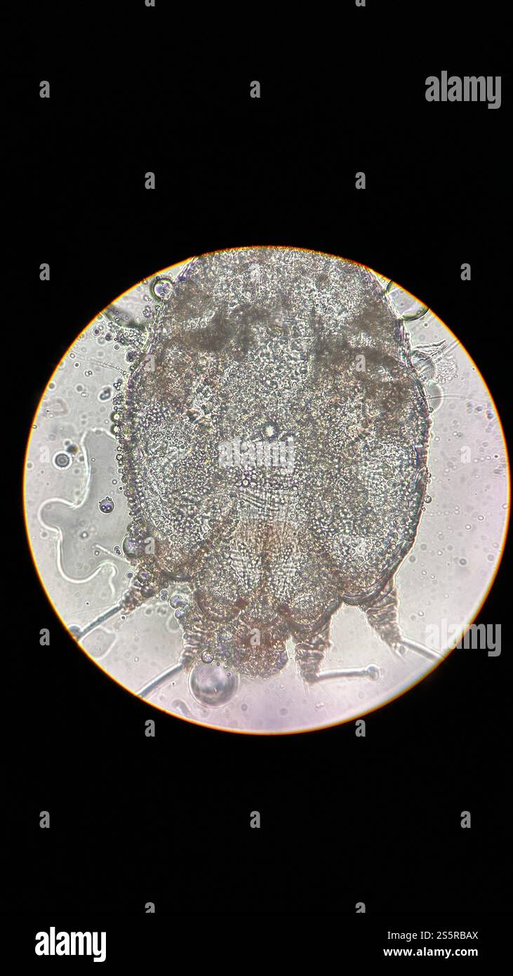 Dermatoscope image of a scabies mite (Sarcoptes scabiei) extracted from ...