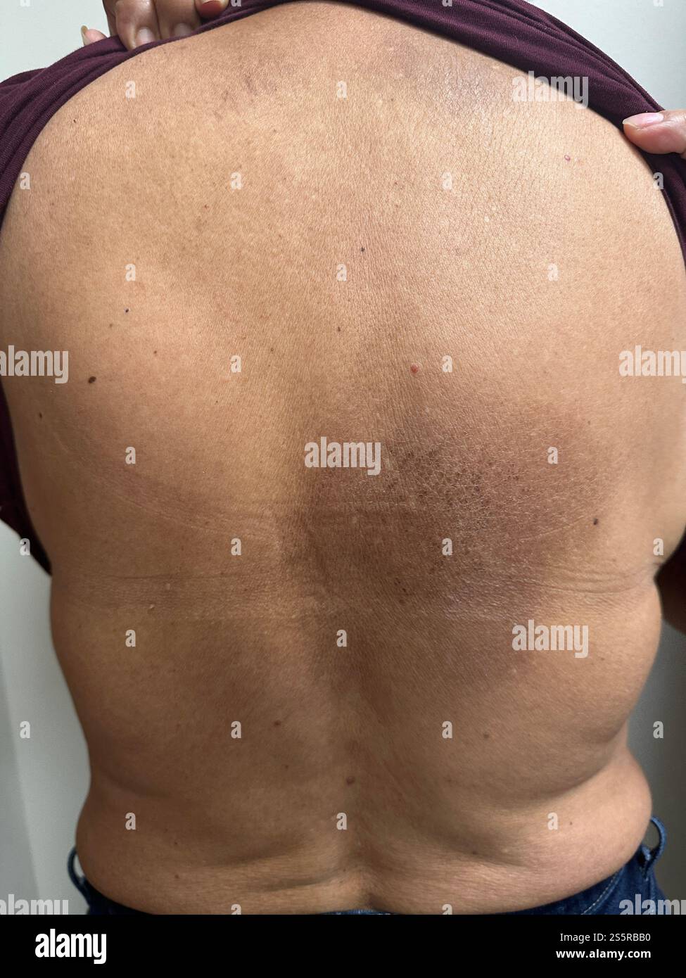 Notalgia paresthetica. This is a disorder of the nerves in the upper ...