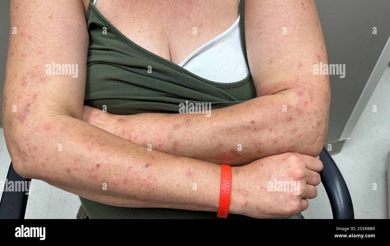 Arms of a patient infected with scabies. Scabies is caused by the mite ...