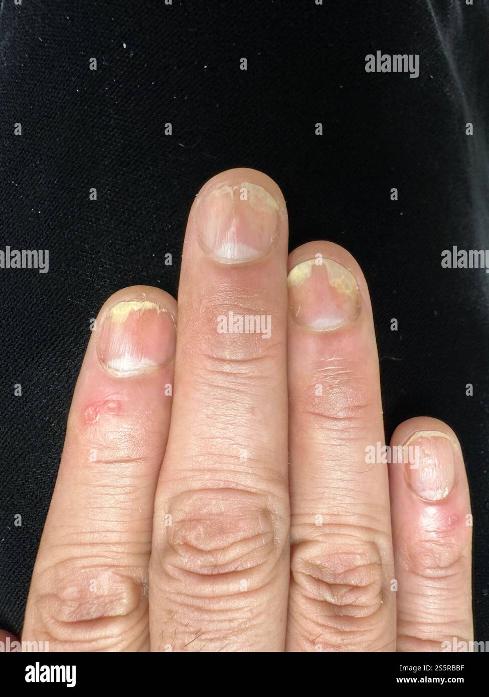 Psoriasis on a patient's fingernails. Psoriasis is a skin condition ...