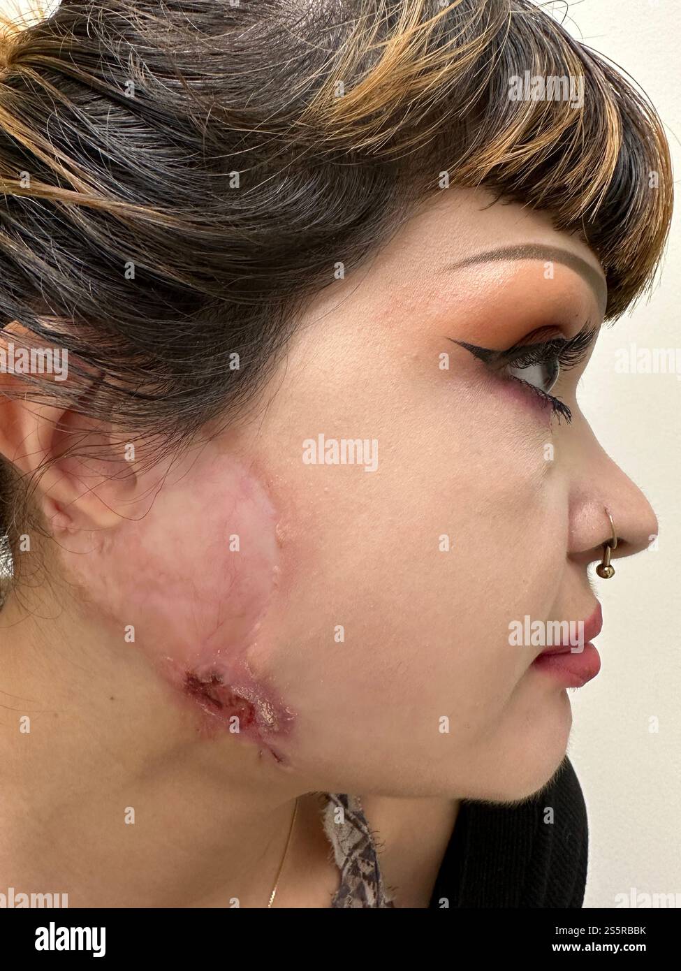 Pyoderma gangrenosum lesions on the face of a patient who is being ...