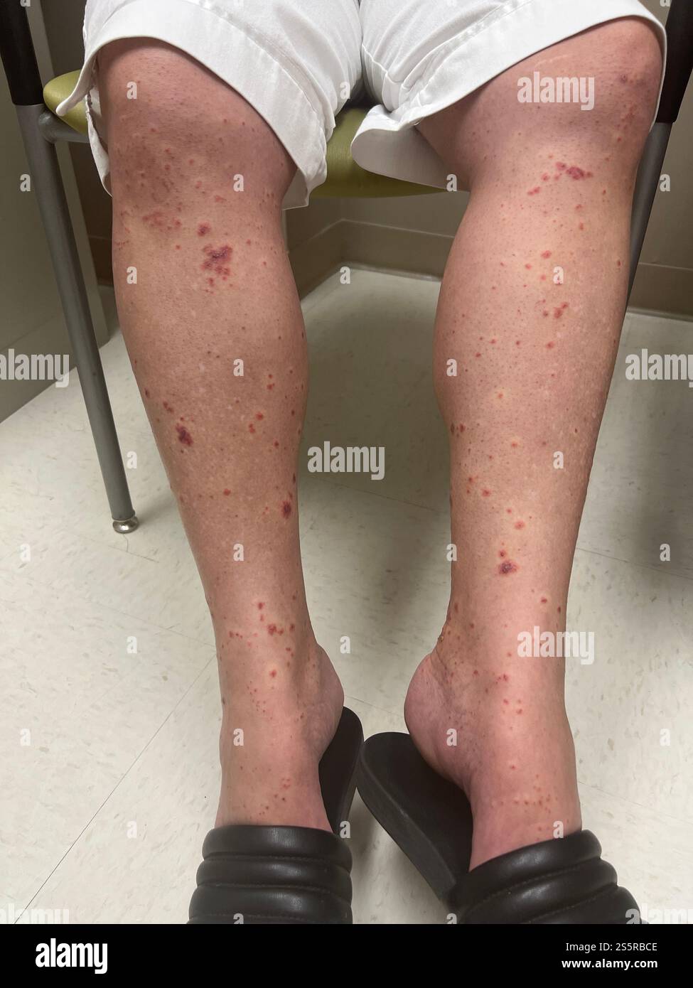 Legs of a patient with vasculitis. Vasculitis is an inflammation of the ...