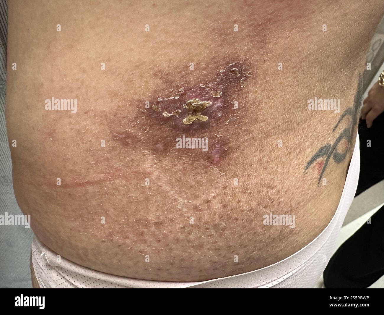 Rash on the hip, known as the holster sign, of a female Hispanic ...