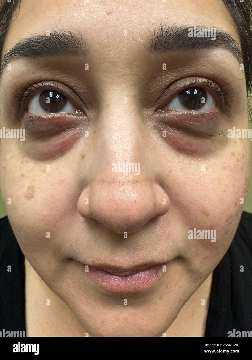 Face of a Hispanic female patient with an allergic salute nasal crease ...