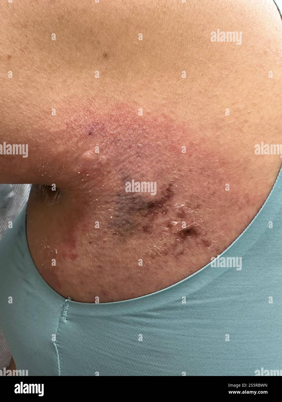 Rash in the armpit of a female Hispanic patient with dermatomyositis ...