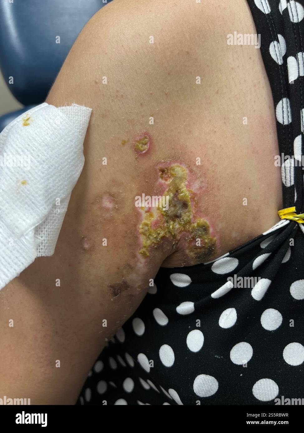 Infection at the site of a previous shave biopsy in a patient with ...