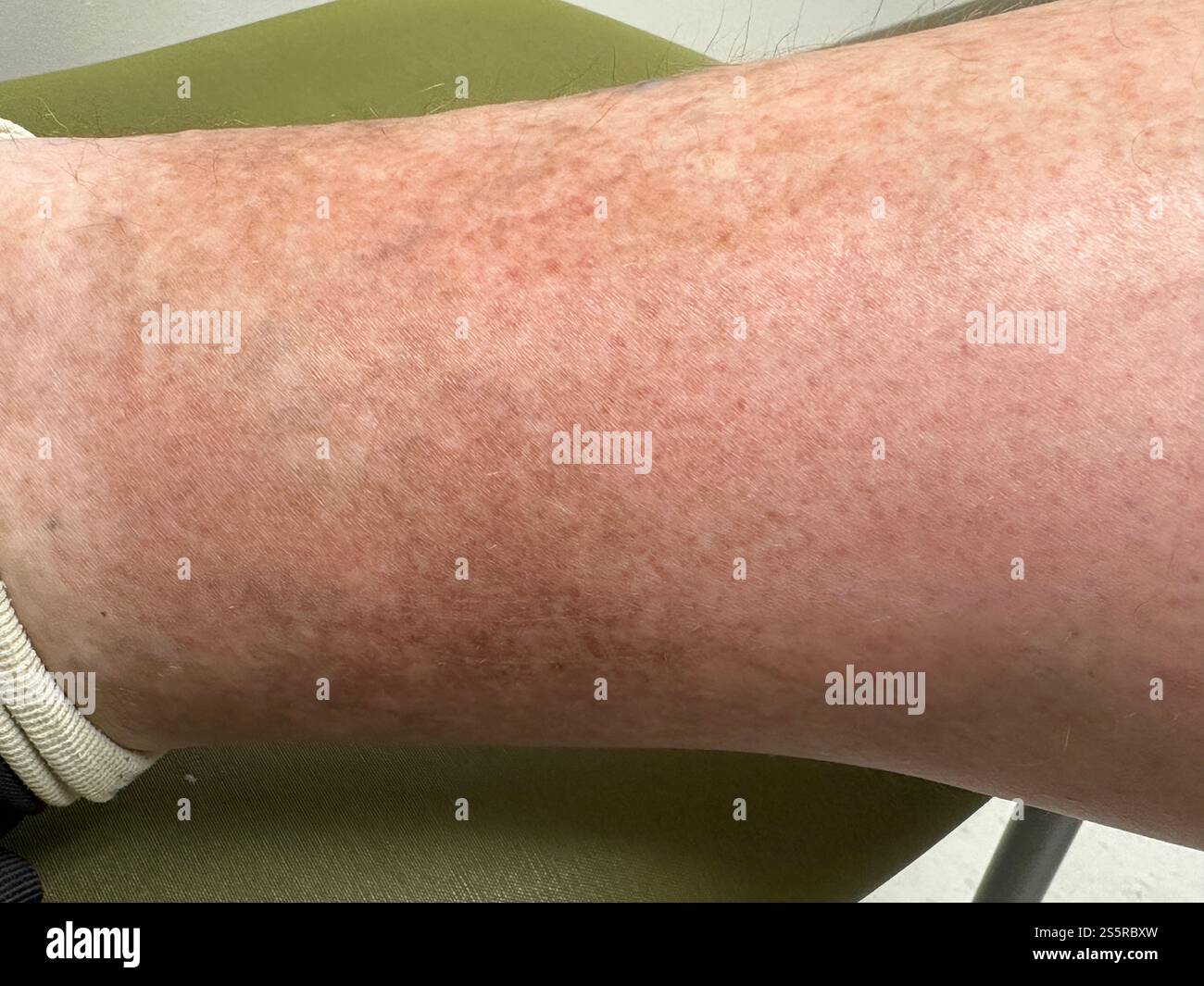 Pigmented purpuric dermatosis (PPD) on a patient's leg. This is a skin ...