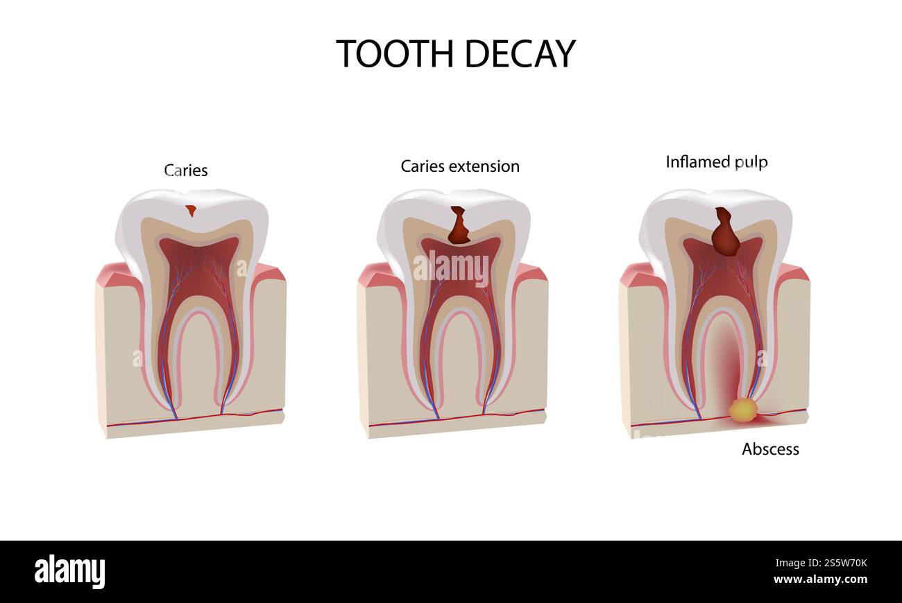 Tooth damage stages, realistic illustration, dental vector Stock Photo ...