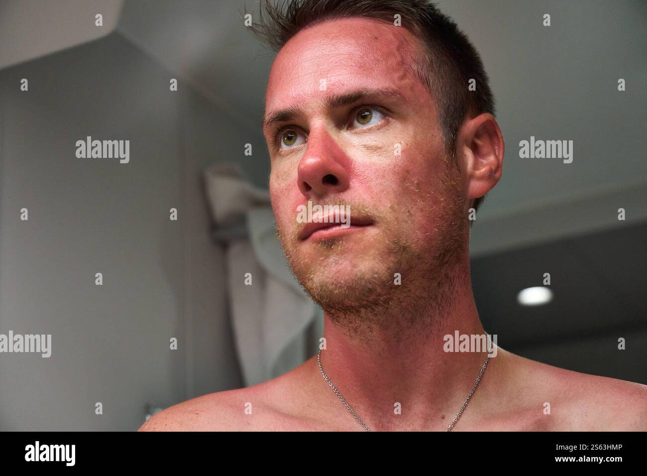 Young man severe sunburn sunburn hi-res stock photography and images ...