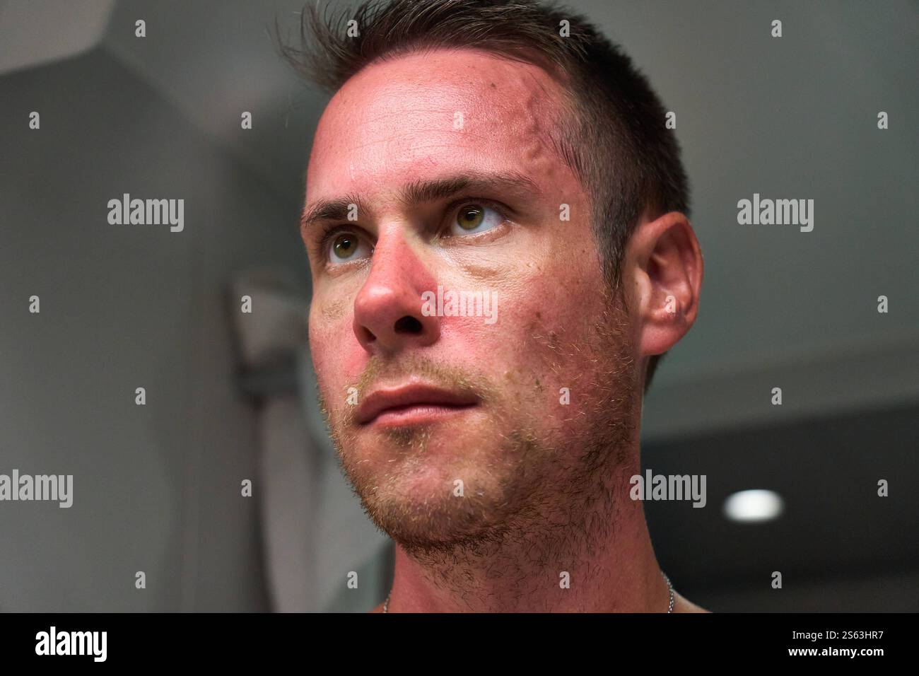 Barbados, Caribbean - January 7, 2025: Young man with severe sunburn on ...