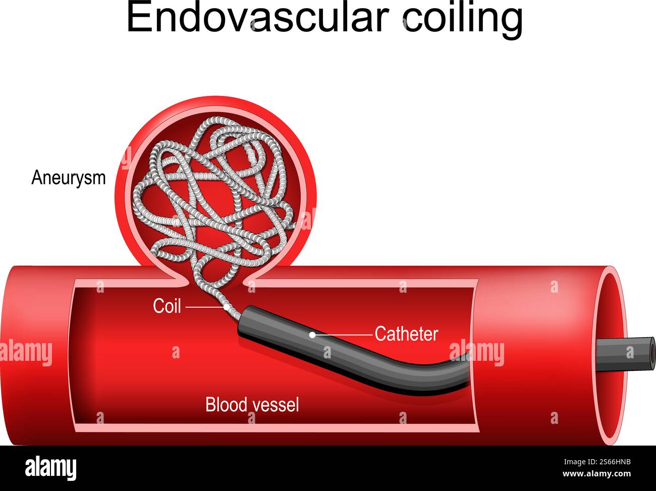 Endovascular Coiling Of Aneurysm Aneurysm Treatment Endovascular Therapy Vector Poster Stock