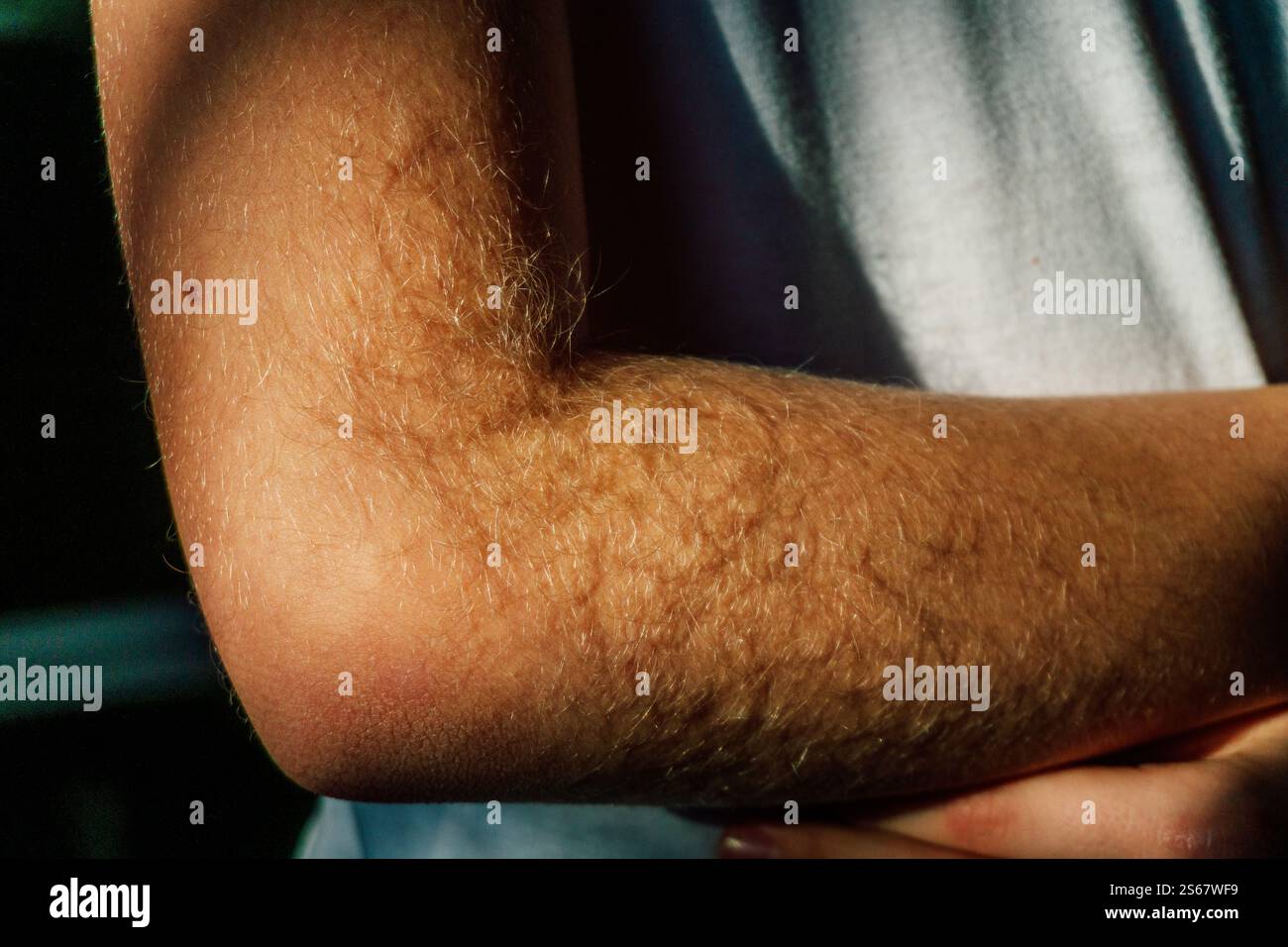 the student has very hairy hands. the problem with the abundant growth ...