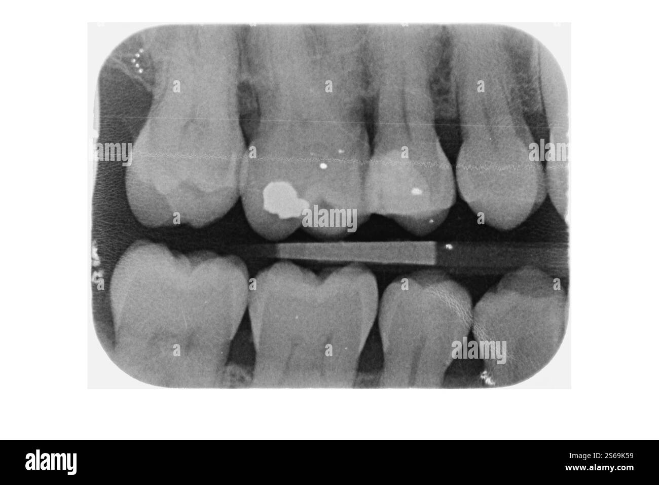 X-Ray image of human teeth - 16 January 2025 Picture by Antony Thompson ...