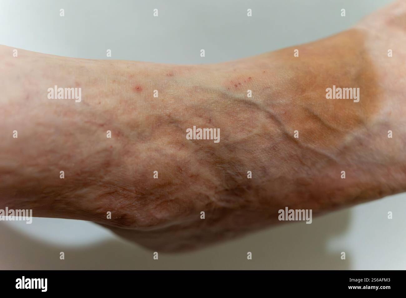 Close examination of an older person's arm showcasing prominent veins ...