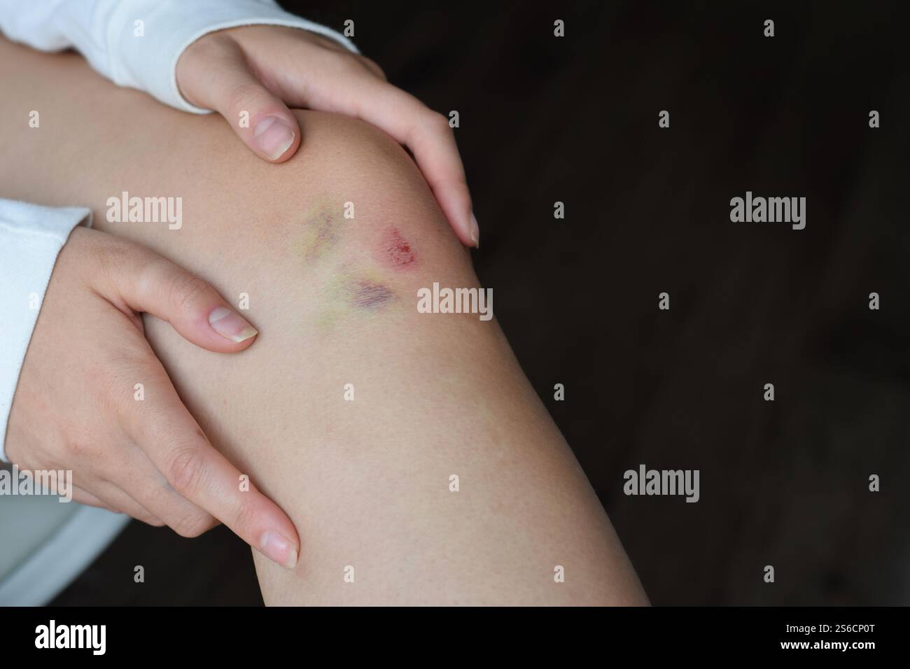 Bruised and scraped skin on person's knee Stock Photo - Alamy