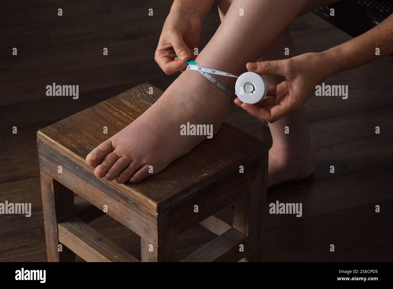 Woman measuring ankle affected by lymphedema condition with tape ...