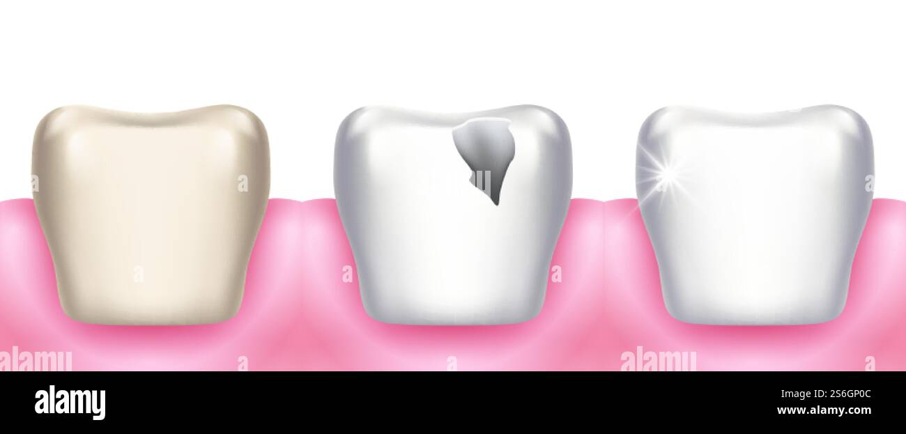 Teeth problems. Tooth decay, dental diseases, infection caries and ...