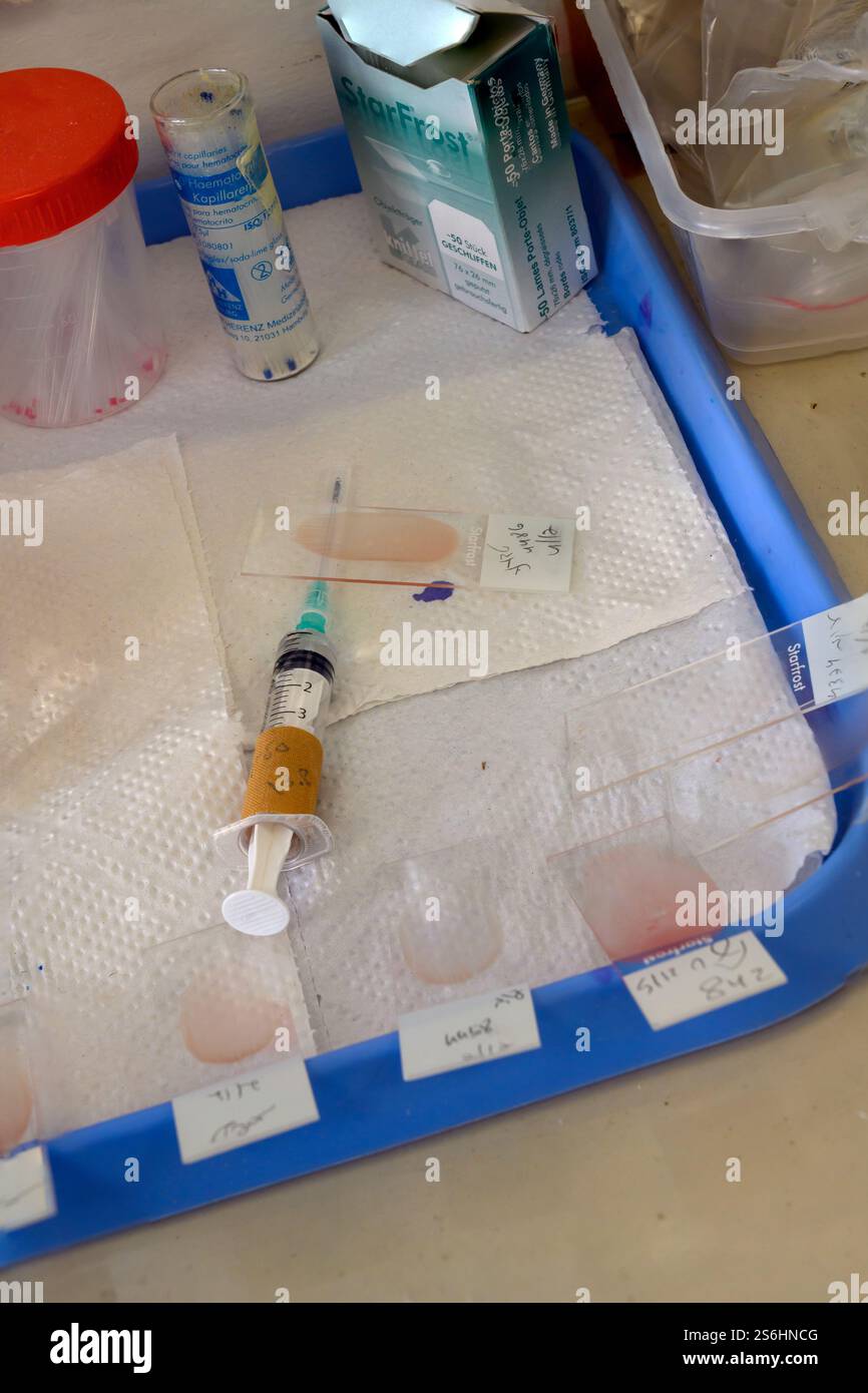 blood samples on glass slides are being prepared to be viewed under an ...