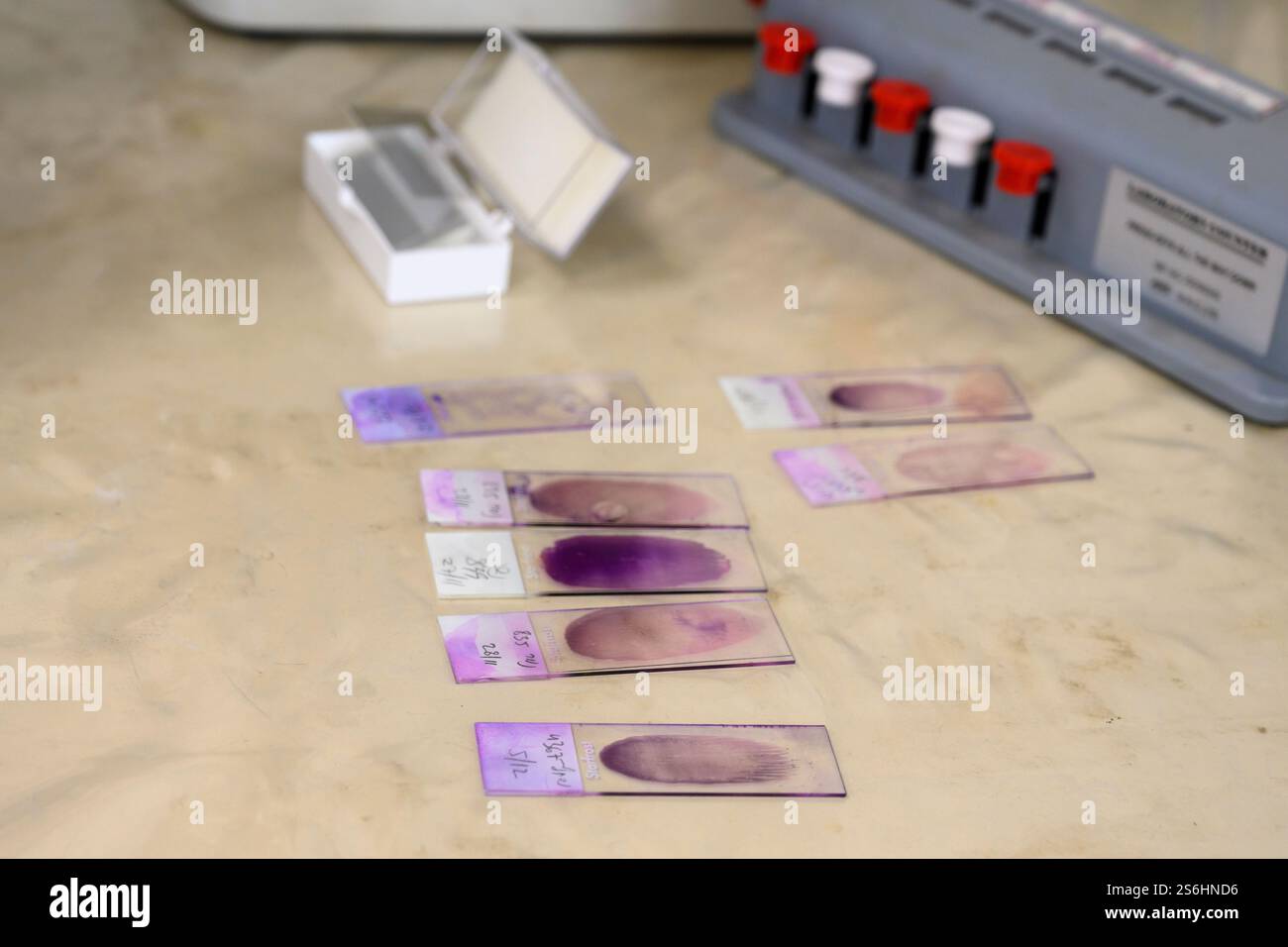 blood samples on glass slides are being prepared to be viewed under an ...