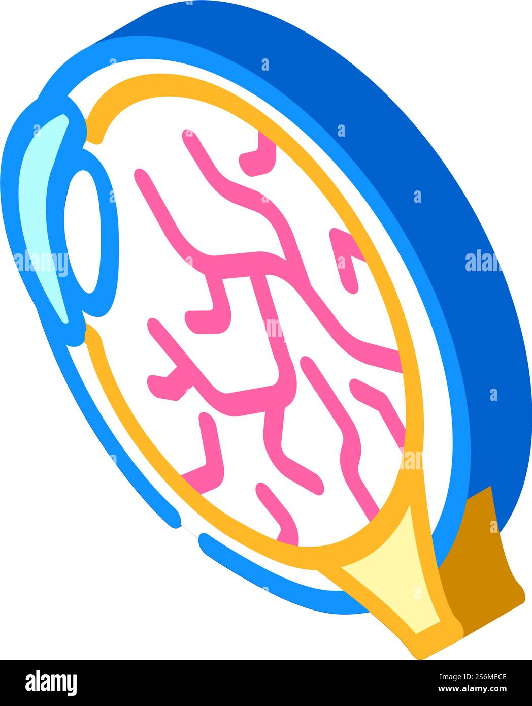 inflammation of eye ophthalmology isometric icon vector. inflammation ...
