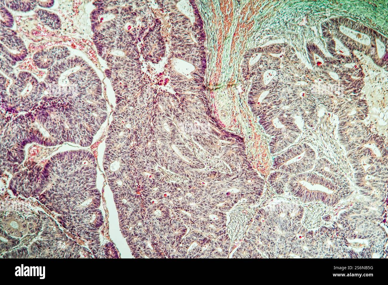 Carcinoma arising from adenoma, 100x Stock Photo - Alamy