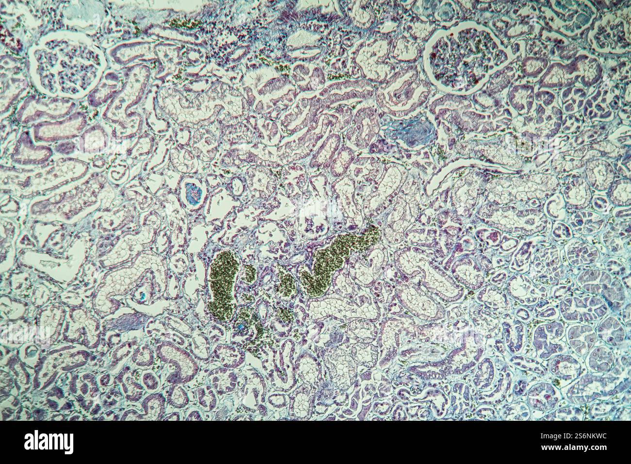 Fibrin deposits in the kidney, 100x Stock Photo - Alamy