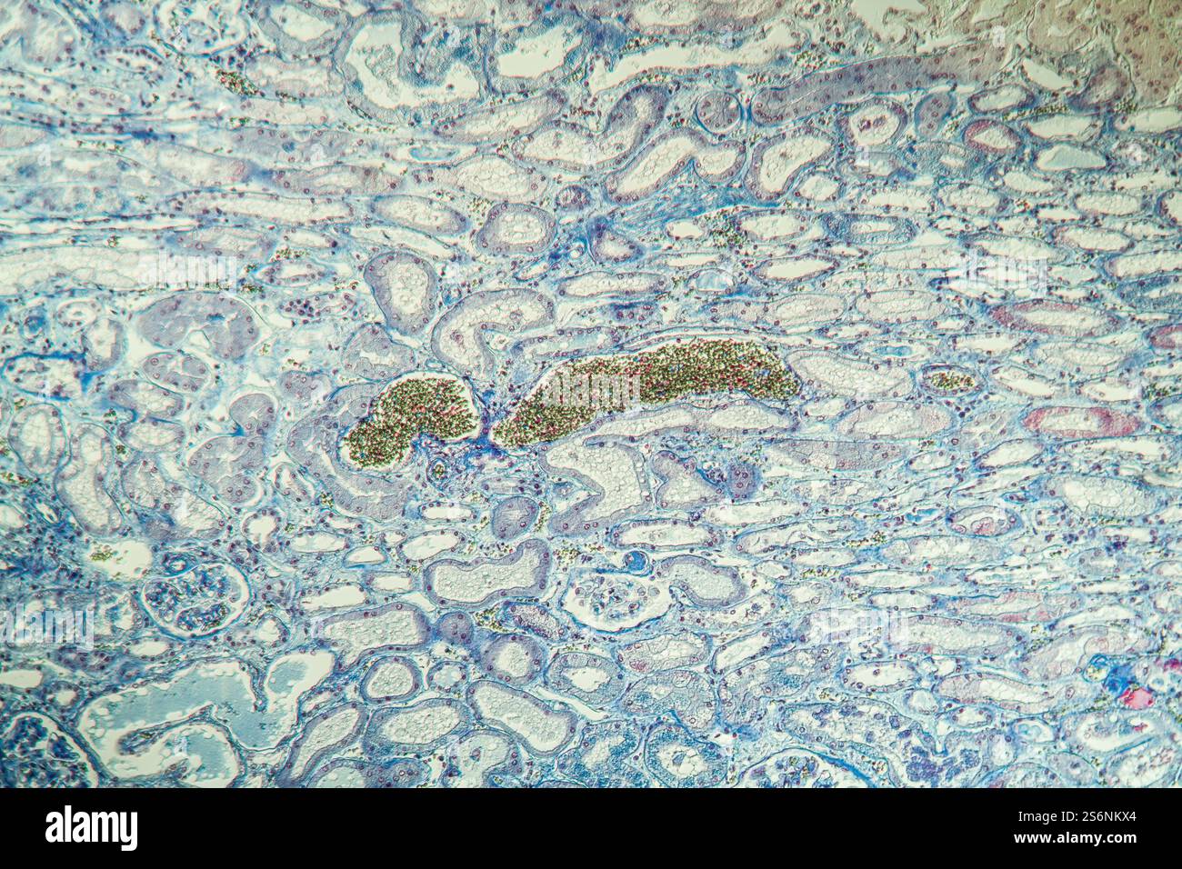 Fibrin deposits in the kidney hi-res stock photography and images - Alamy