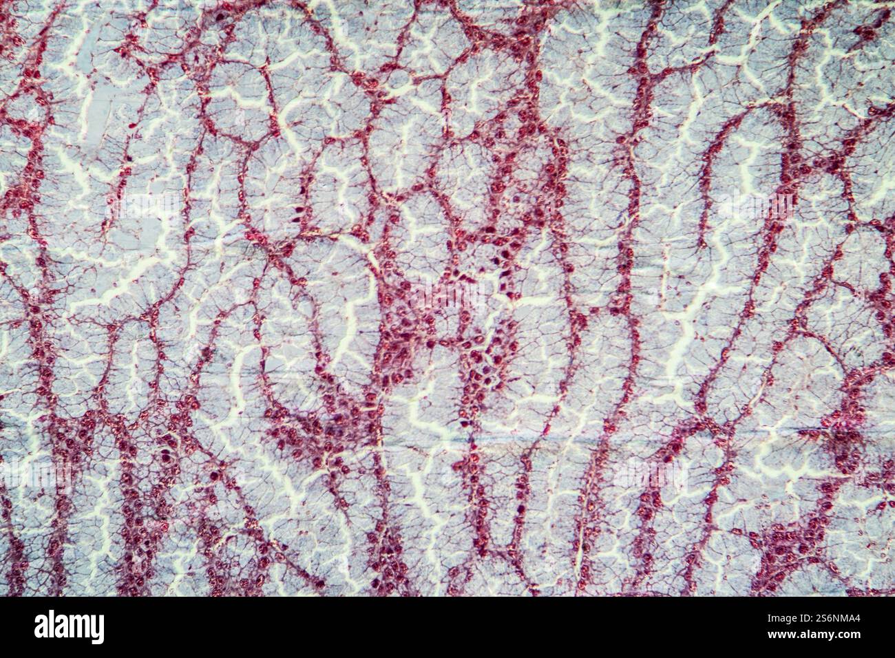 Enlarged adenoids gland hi-res stock photography and images - Alamy