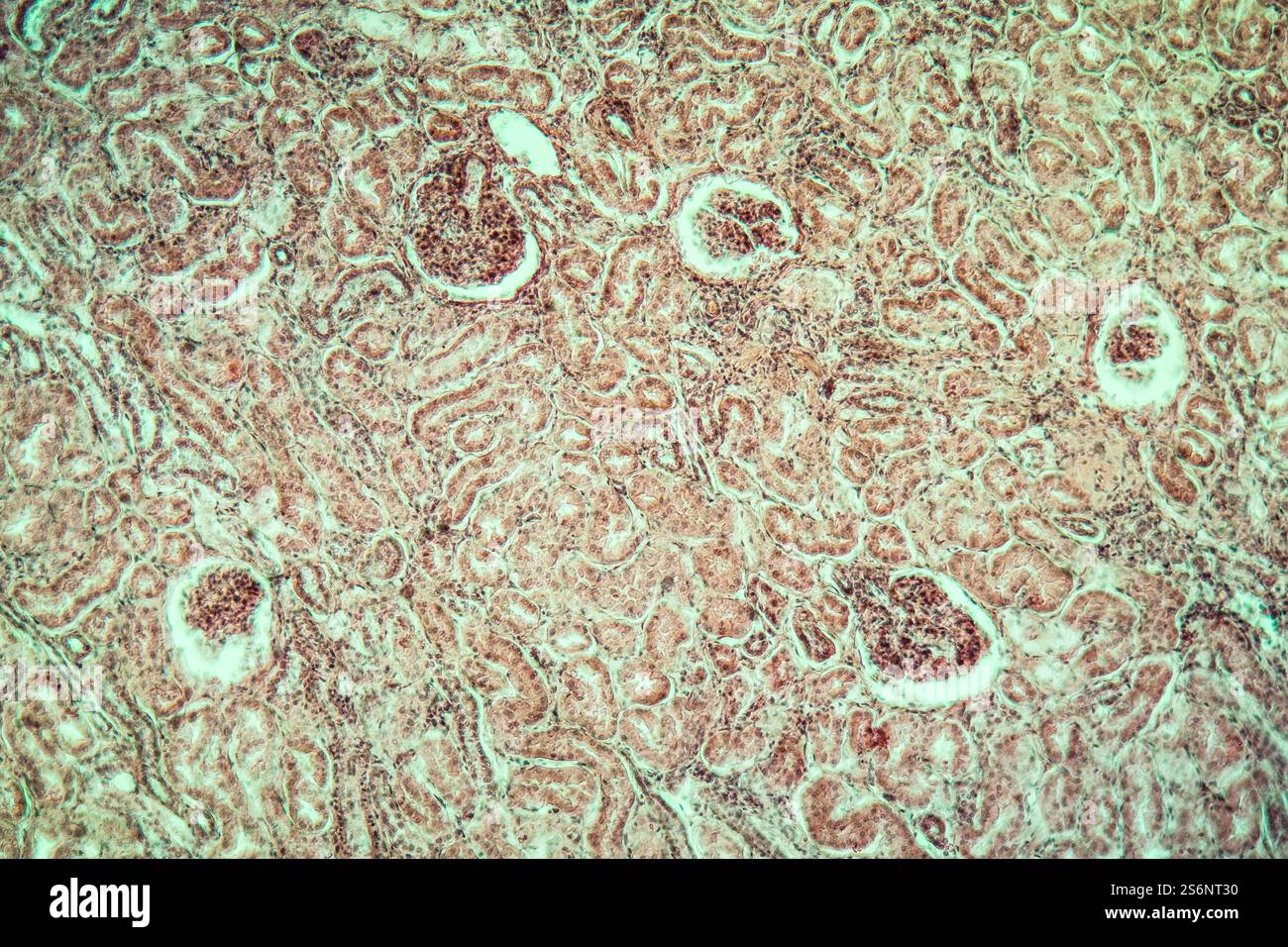 Kidney Tuberculosis Diseased tissue 100x Stock Photo - Alamy