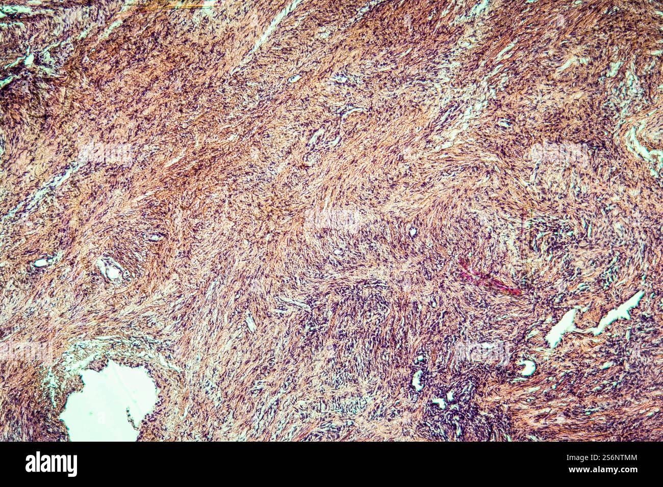 Heart muscle diseased tissue 100x Stock Photo - Alamy