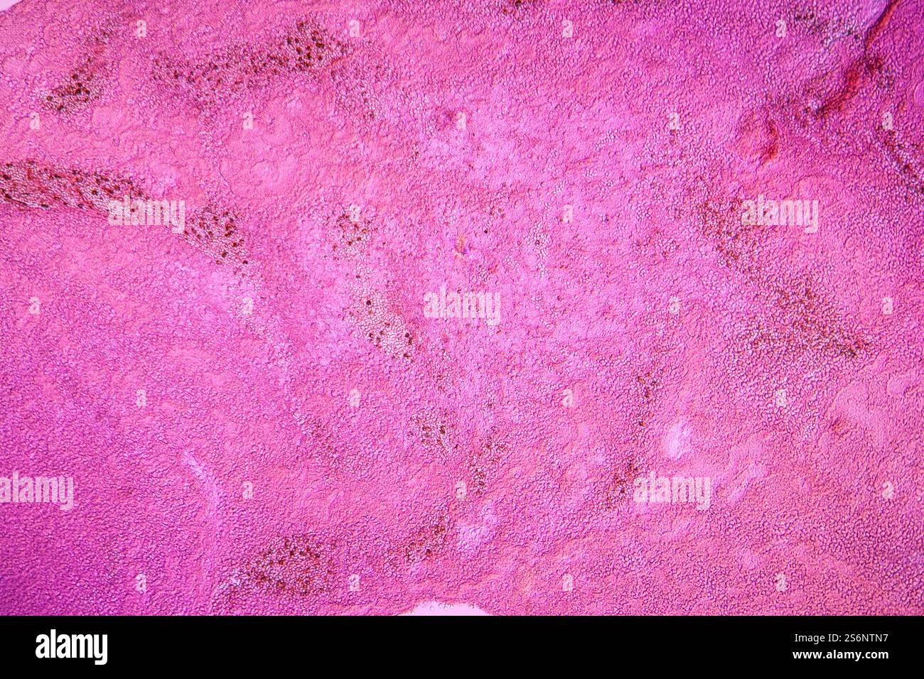Fatty heart diseased tissue 100x Stock Photo - Alamy