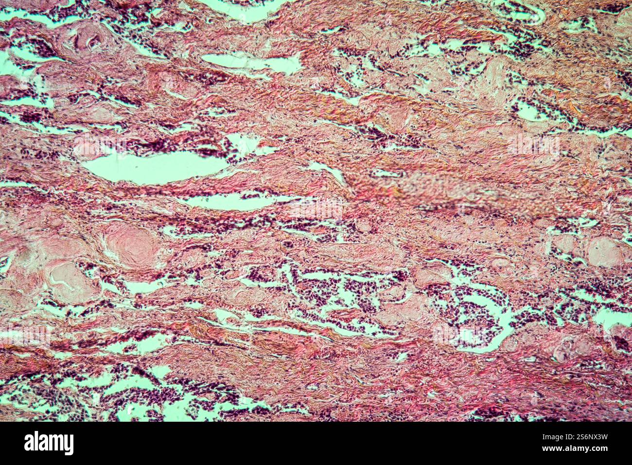 Mixed tumor diseased tissue 100x Stock Photo - Alamy