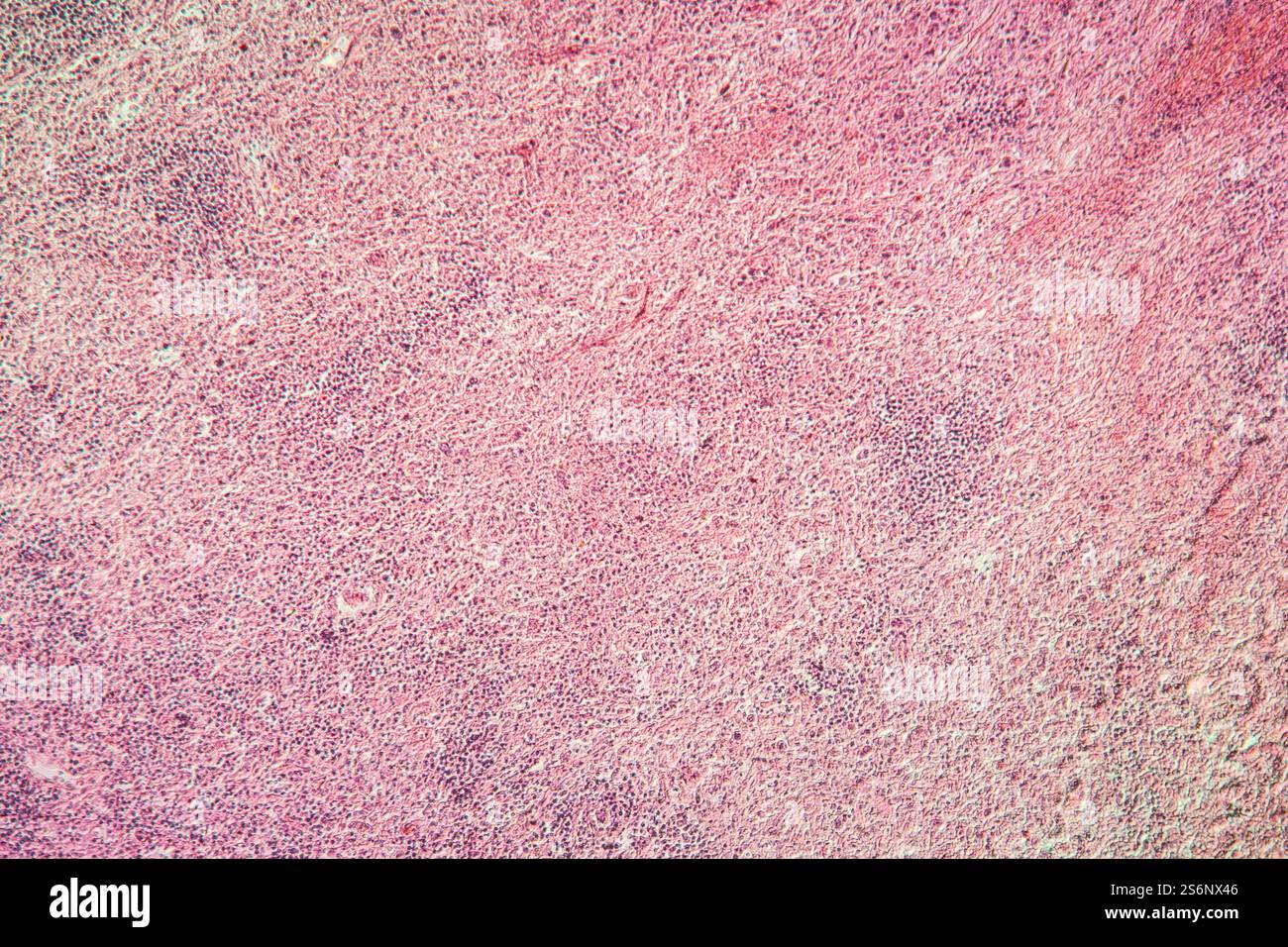 Sarcoma disease hi-res stock photography and images - Alamy