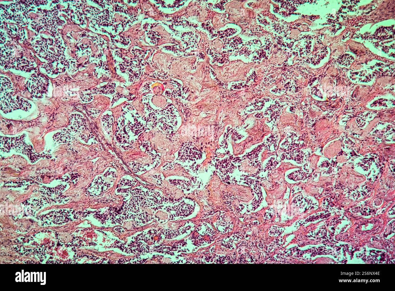 Mixed tumor diseased tissue 100x Stock Photo - Alamy