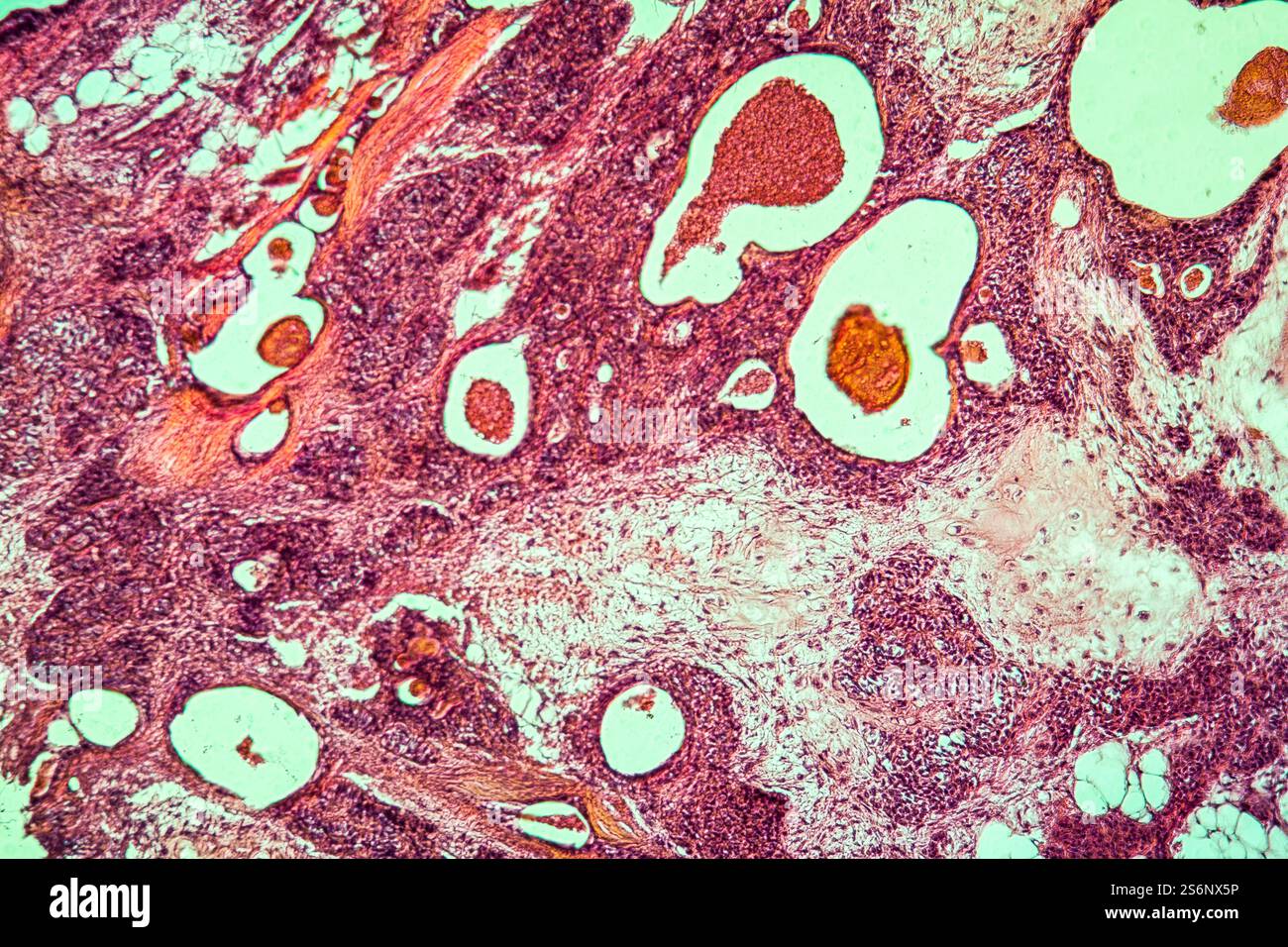 Mixed tumor diseased tissue 100x Stock Photo - Alamy